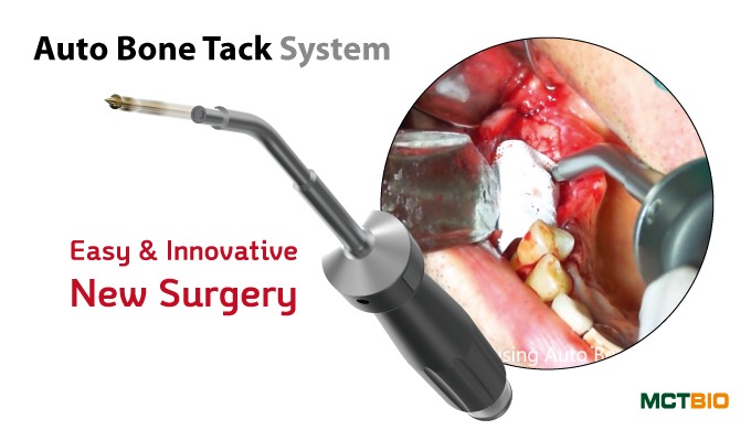 Automatic bone tack system (by MCTBIO CO., LTD)